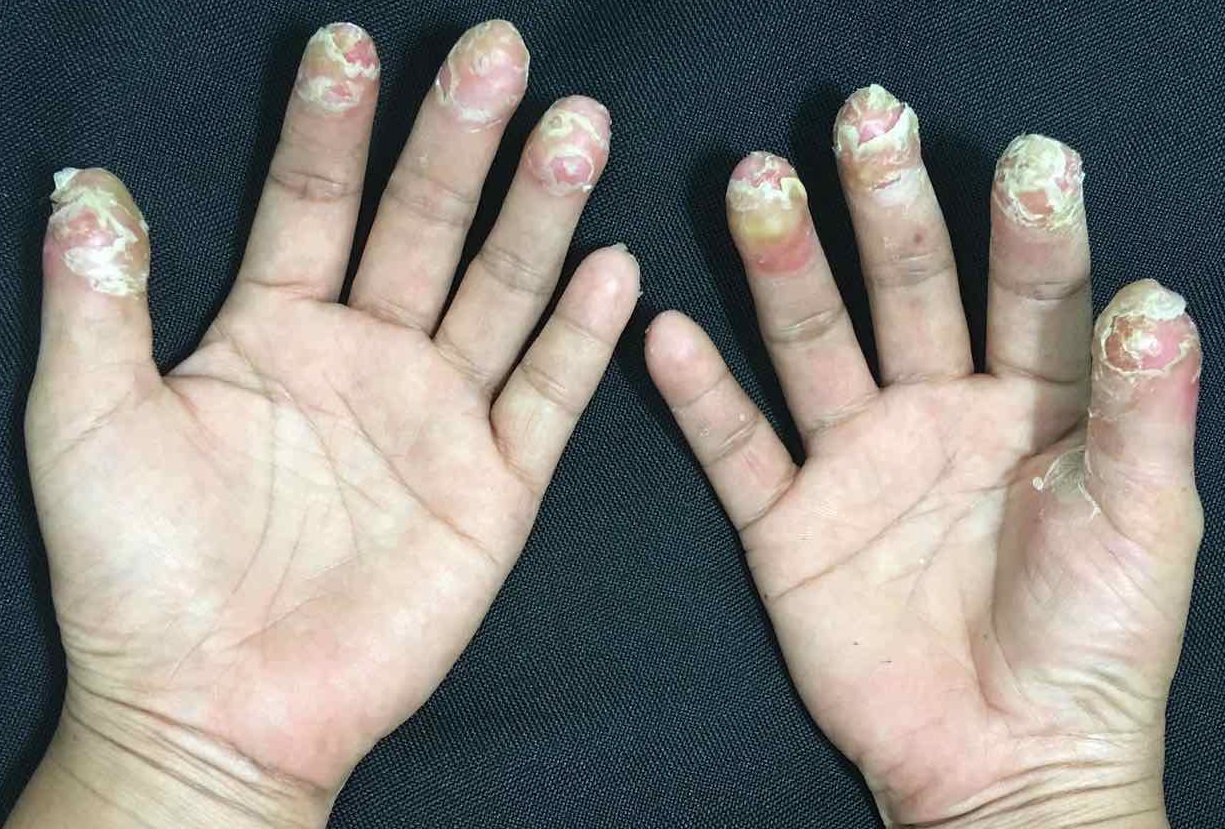 Acrodermatitis continua of Hallopeau in a 47-year-old female
