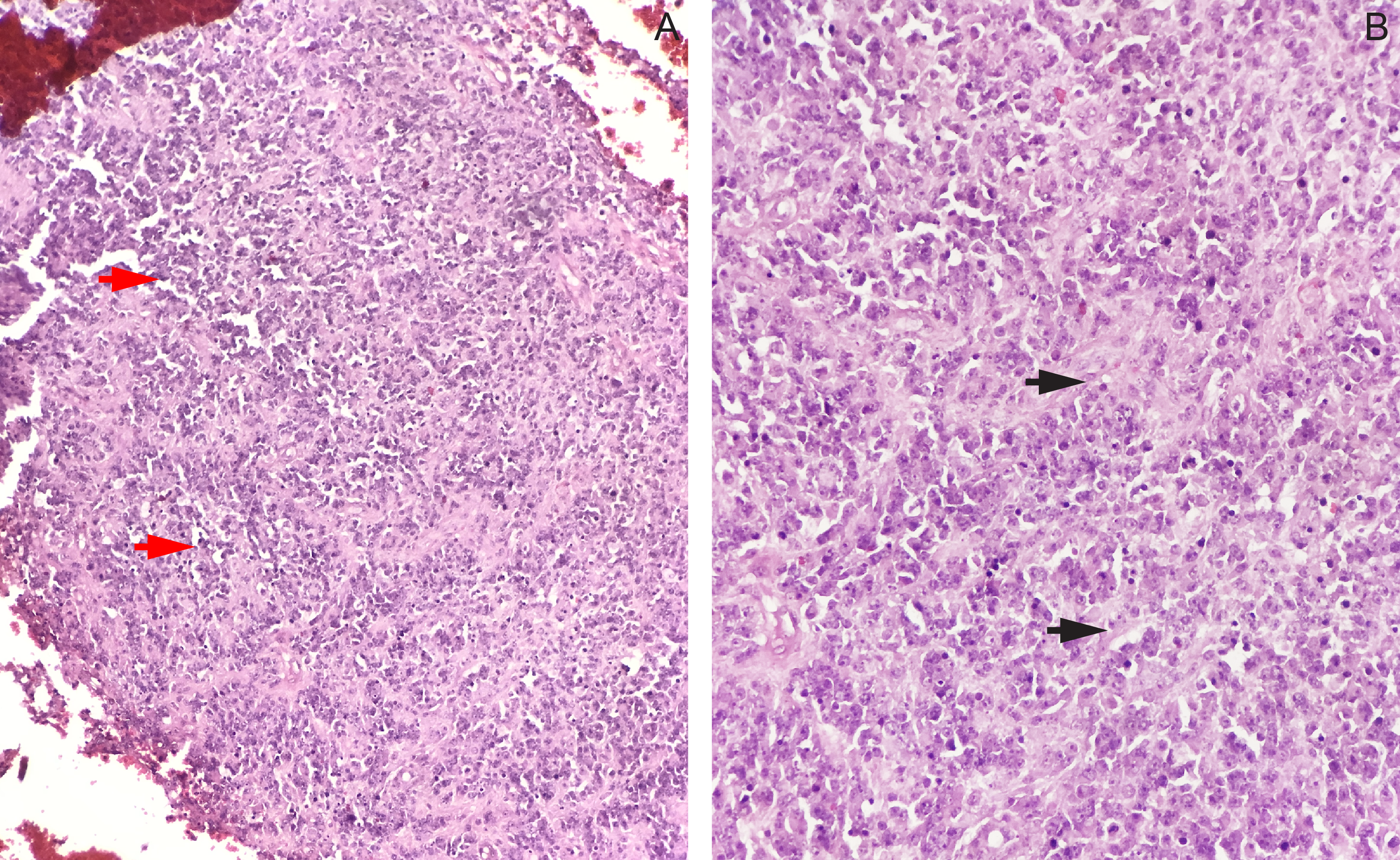 Extrarenal rhabdoid tumor in a 12-year-old female: case in images