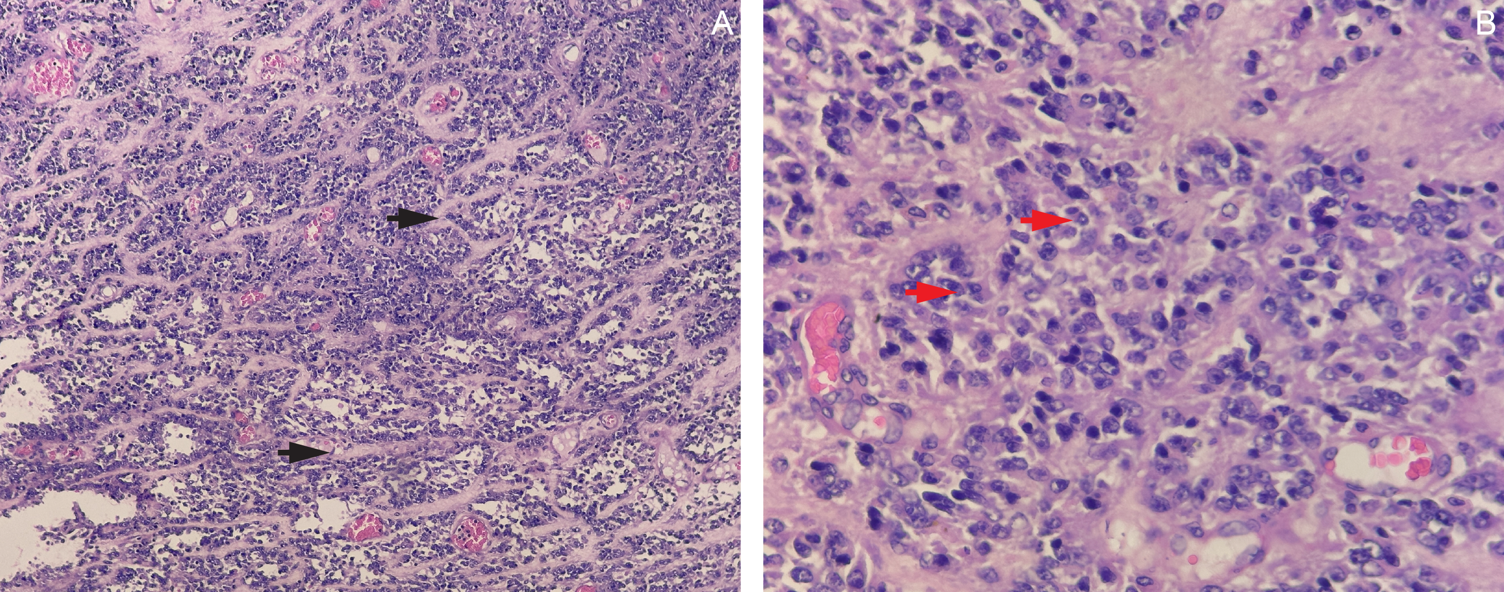 Extrarenal rhabdoid tumor in a 12-year-old female: case in images