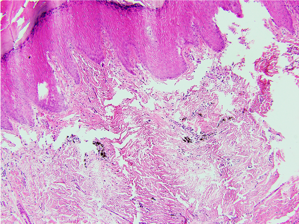 Madura foot in a 42-year-old male: case in images